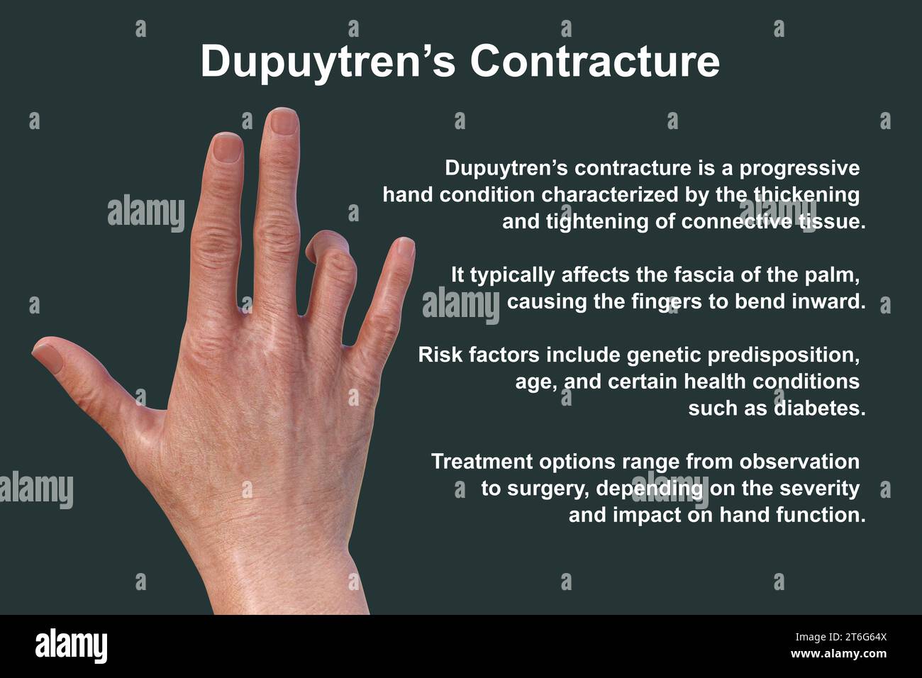 Hand of a patient with Dupuytren's contracture, a condition that causes ...