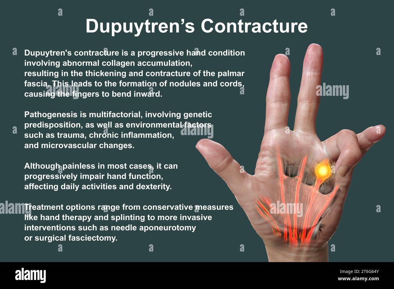 A 3D medical illustration displaying a patient's hand with Dupuytren's ...