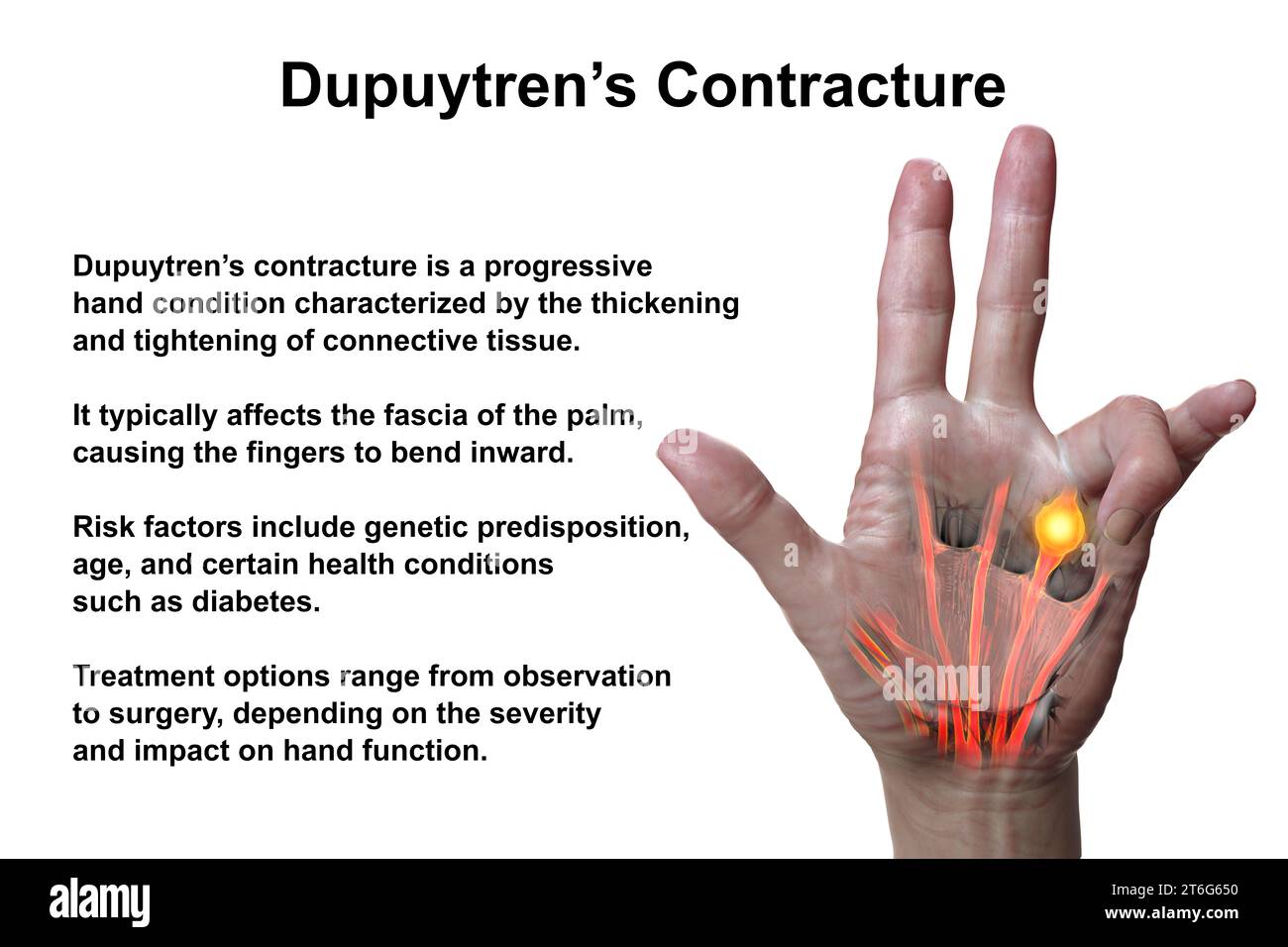 A 3D medical illustration displaying a patient's hand with Dupuytren's ...
