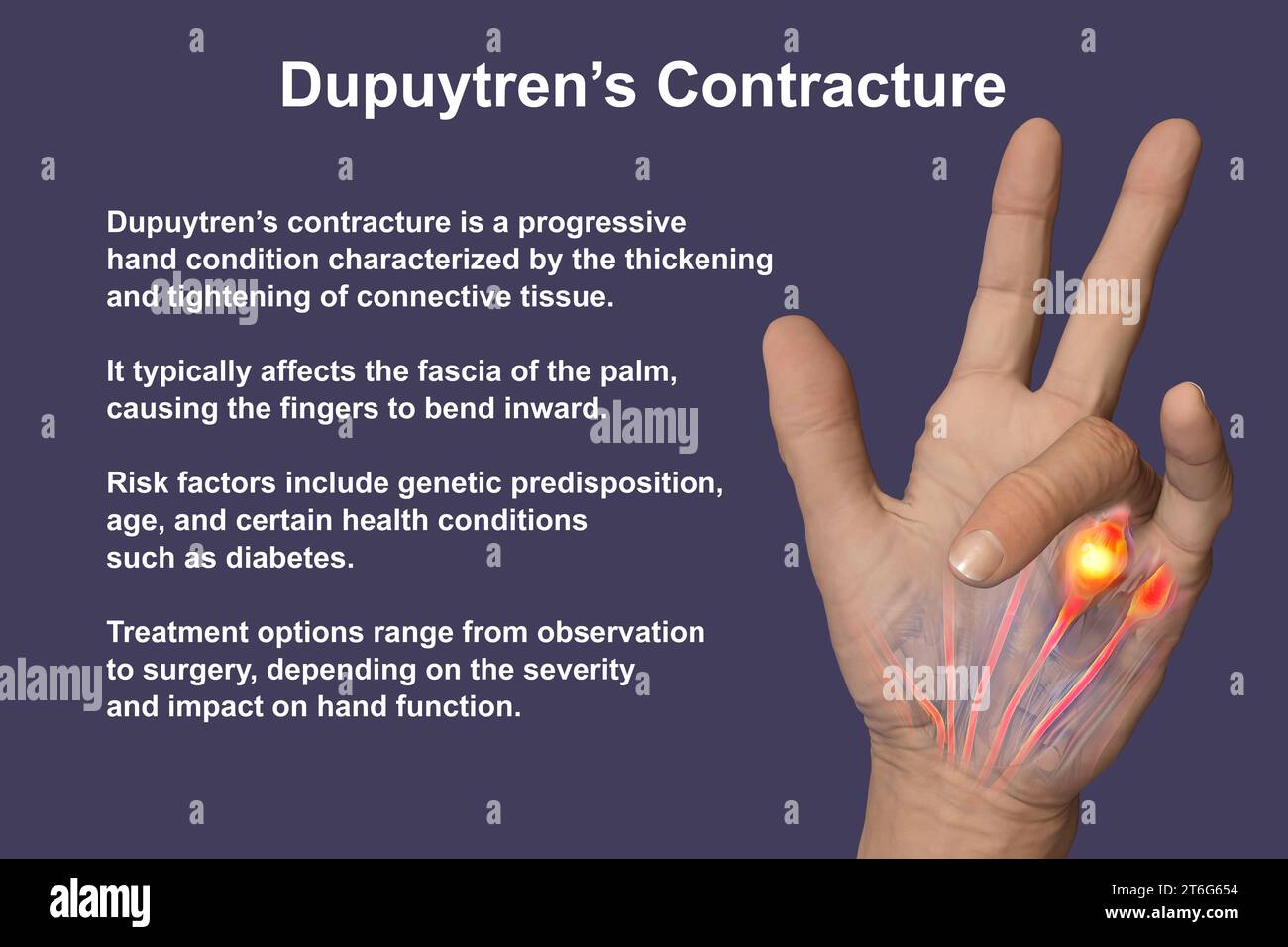 A 3D medical illustration displaying a patient's hand with Dupuytren's ...