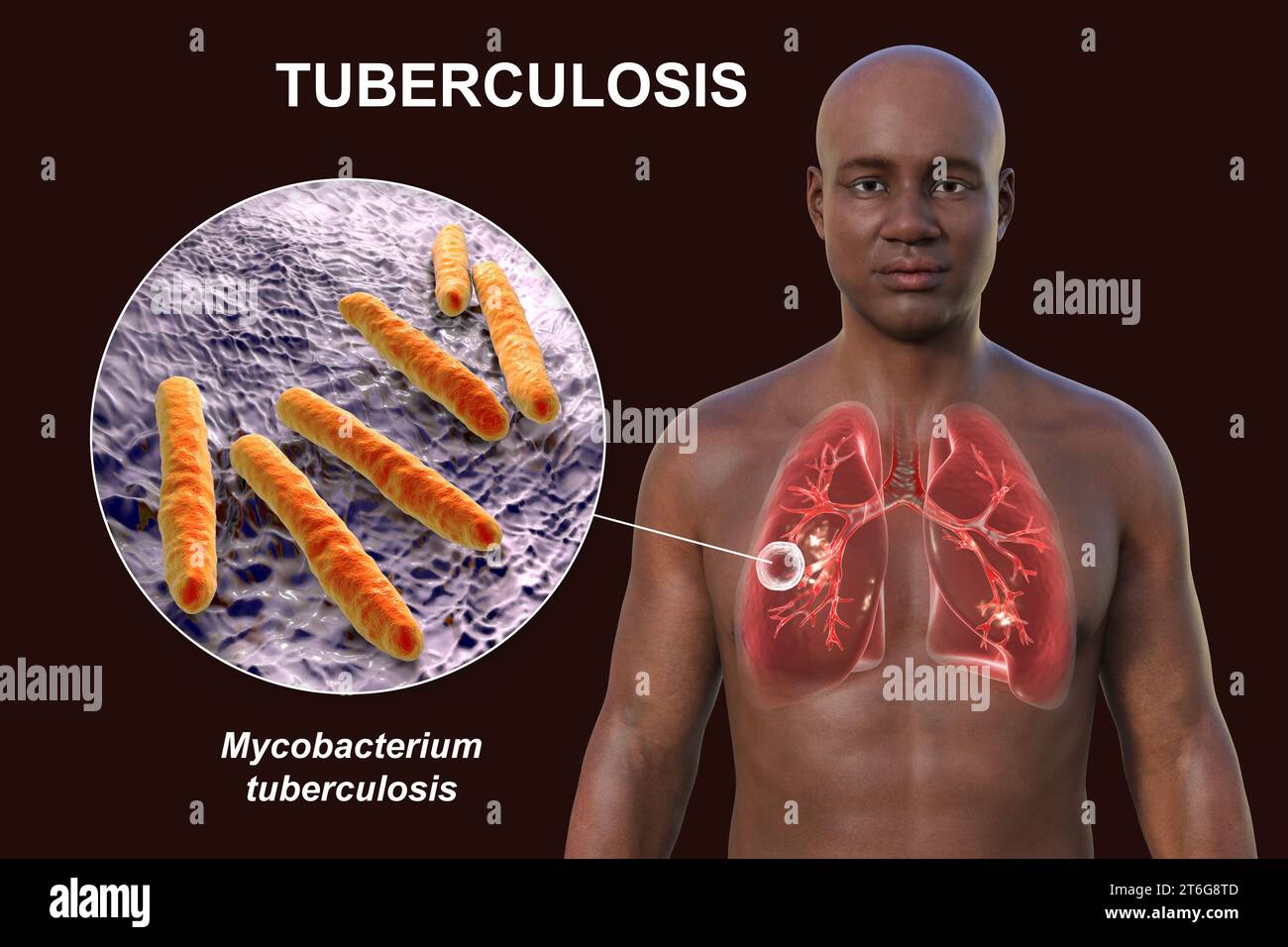 Man with cavernous tuberculosis hi-res stock photography and images - Alamy