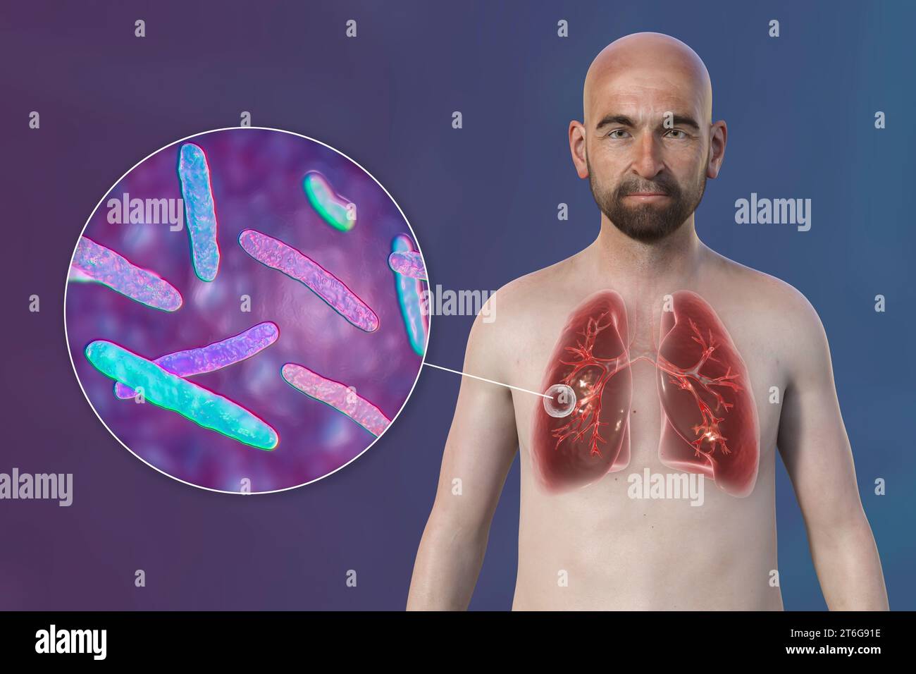 Man with cavernous tuberculosis hi-res stock photography and images - Alamy