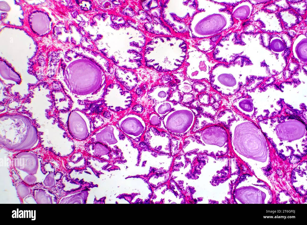 Micrograph of prostatic hyperplasia, showing increased glandular tissue ...
