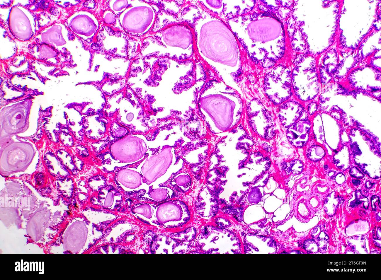Micrograph of prostatic hyperplasia, showing increased glandular tissue ...