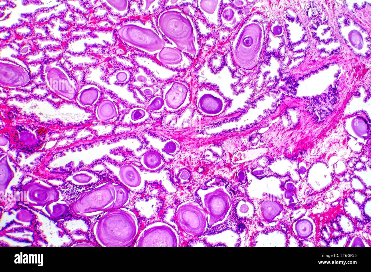 Micrograph of prostatic hyperplasia, showing increased glandular tissue ...
