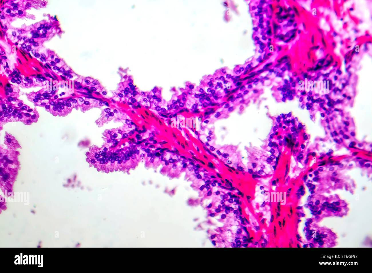 Micrograph of prostatic hyperplasia, showing increased glandular tissue ...