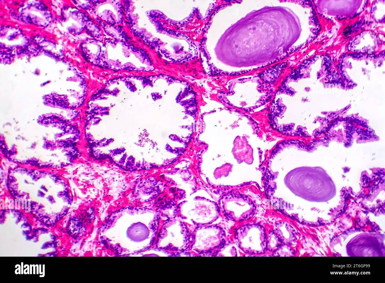 Micrograph of prostatic hyperplasia, showing increased glandular tissue ...