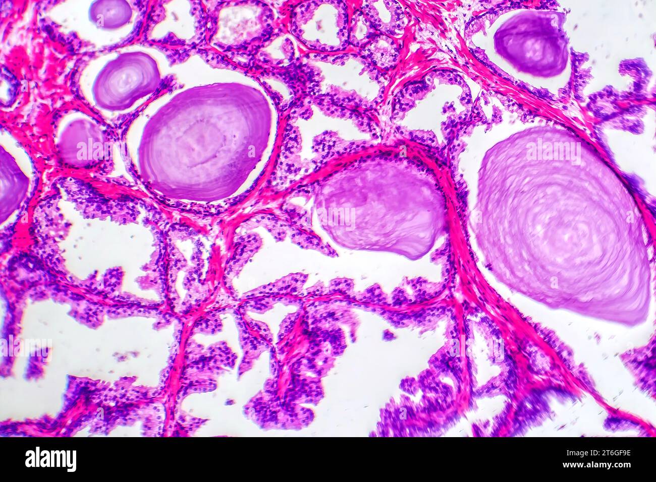 Micrograph of prostatic hyperplasia, showing increased glandular tissue ...