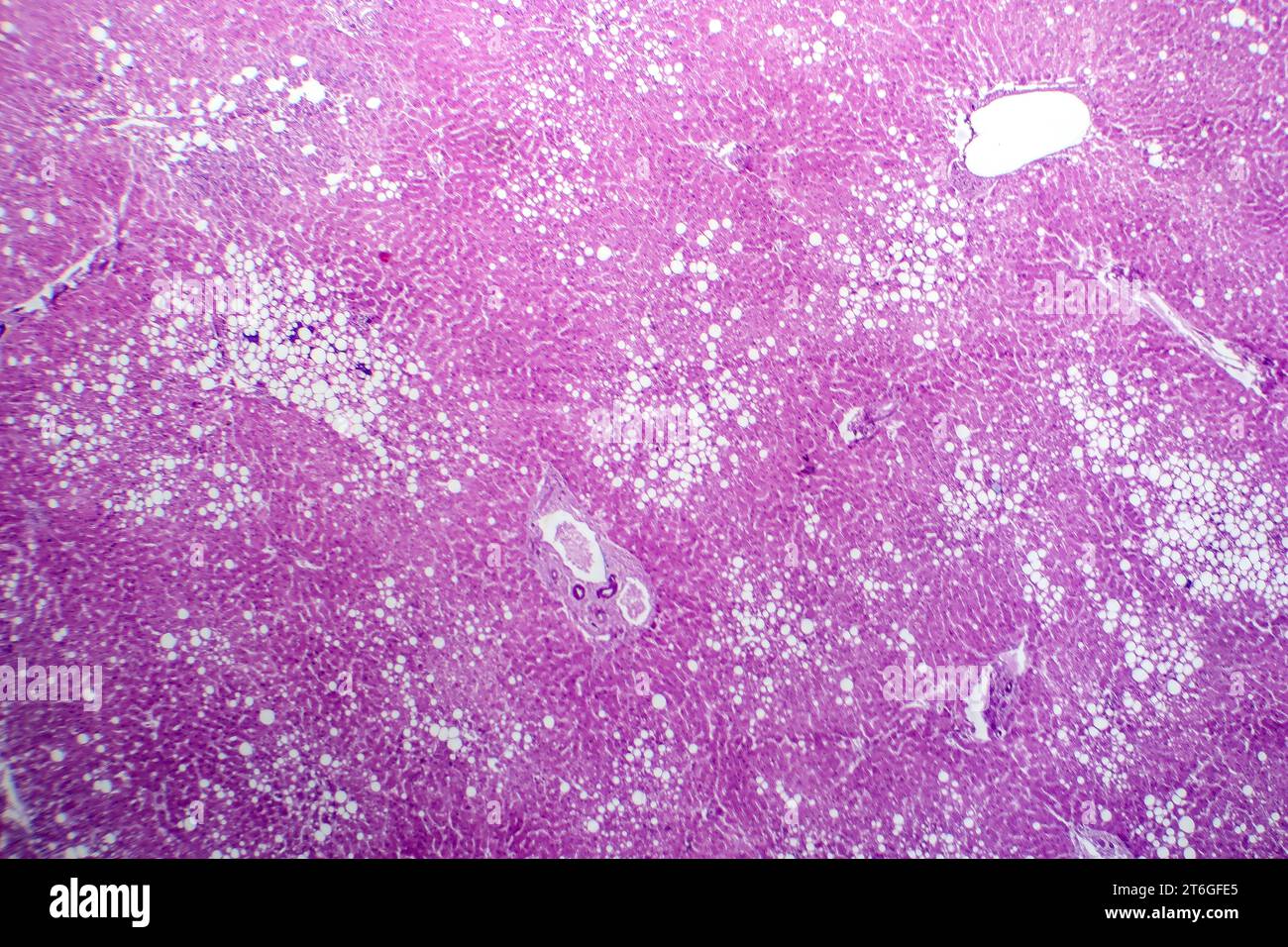 Photomicrograph of hepatic steatosis, revealing fat accumulation in ...
