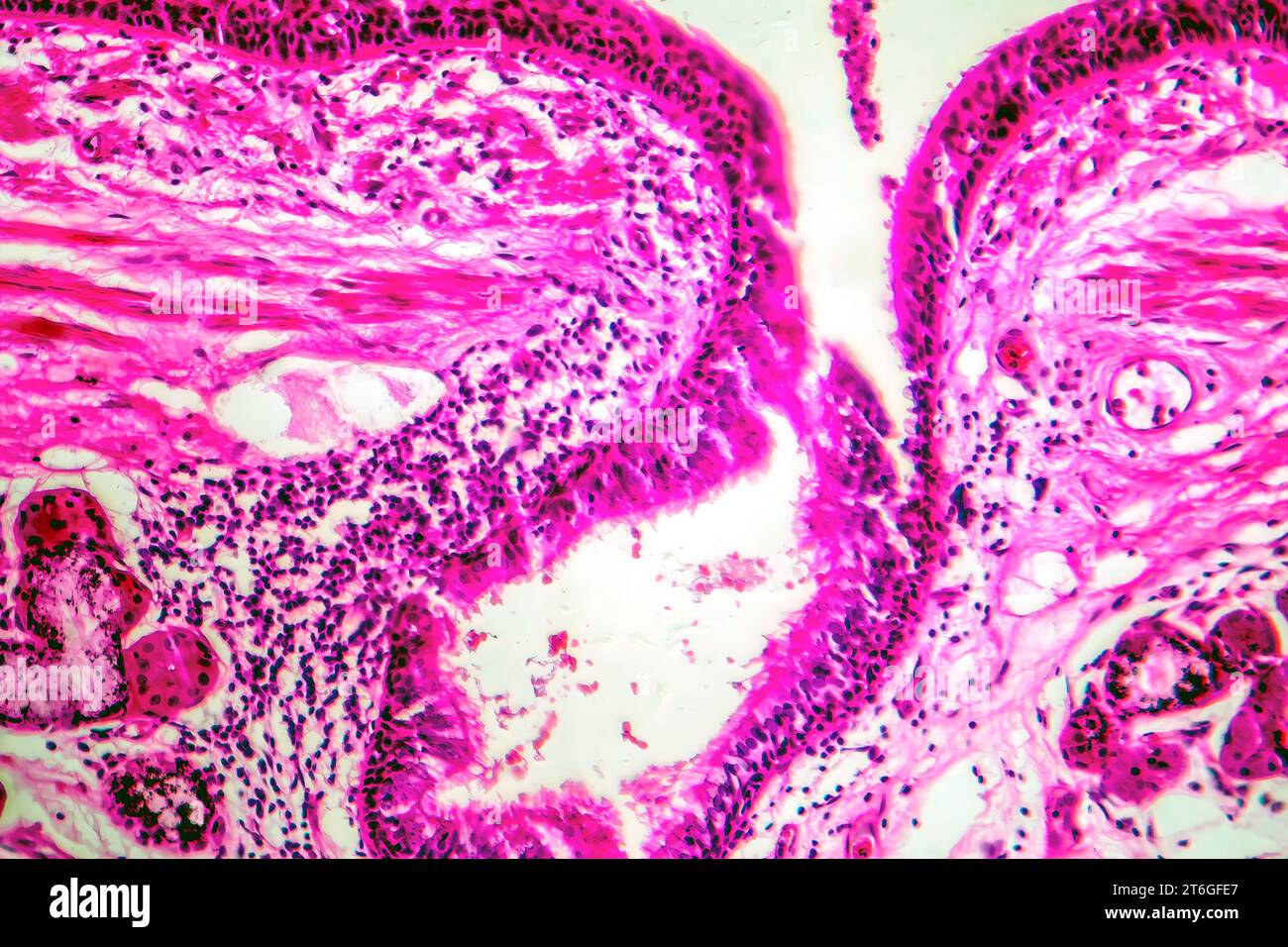 Photomicrograph Of Bronchial Epithelial Squamous Metaplasia Showing Squamous Cell