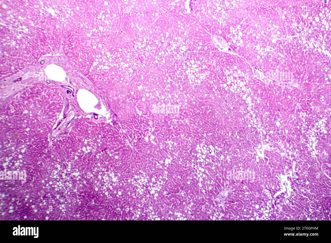 Photomicrograph of hepatic steatosis, revealing fat accumulation in ...