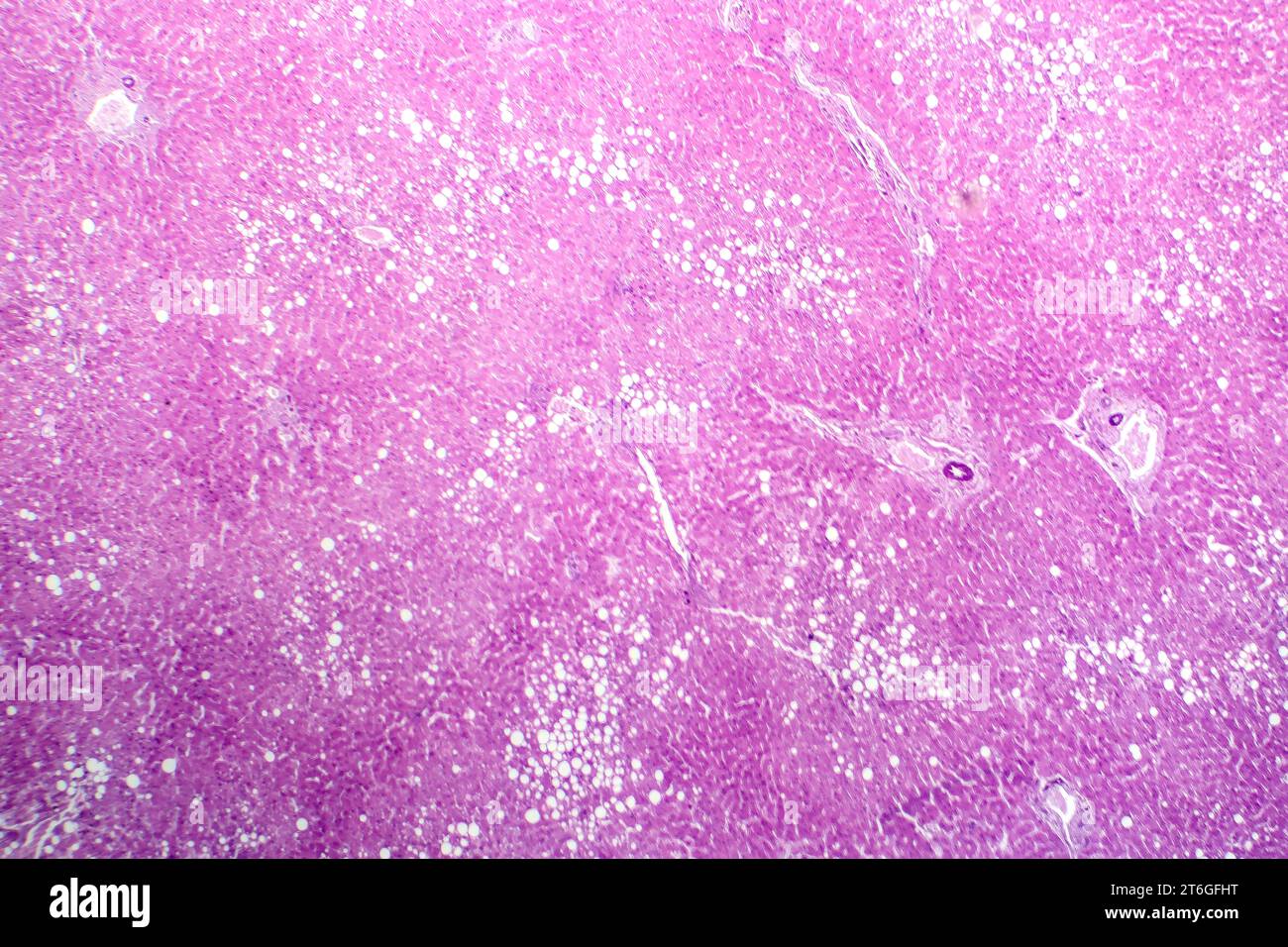 Photomicrograph of hepatic steatosis, revealing fat accumulation in ...