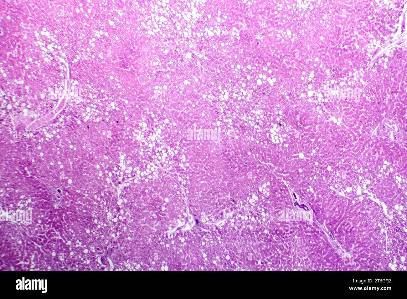 Photomicrograph of hepatic steatosis, revealing fat accumulation in ...