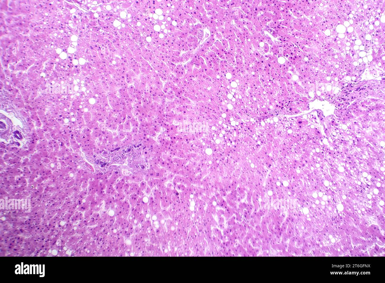 Photomicrograph of hepatic steatosis, revealing fat accumulation in ...
