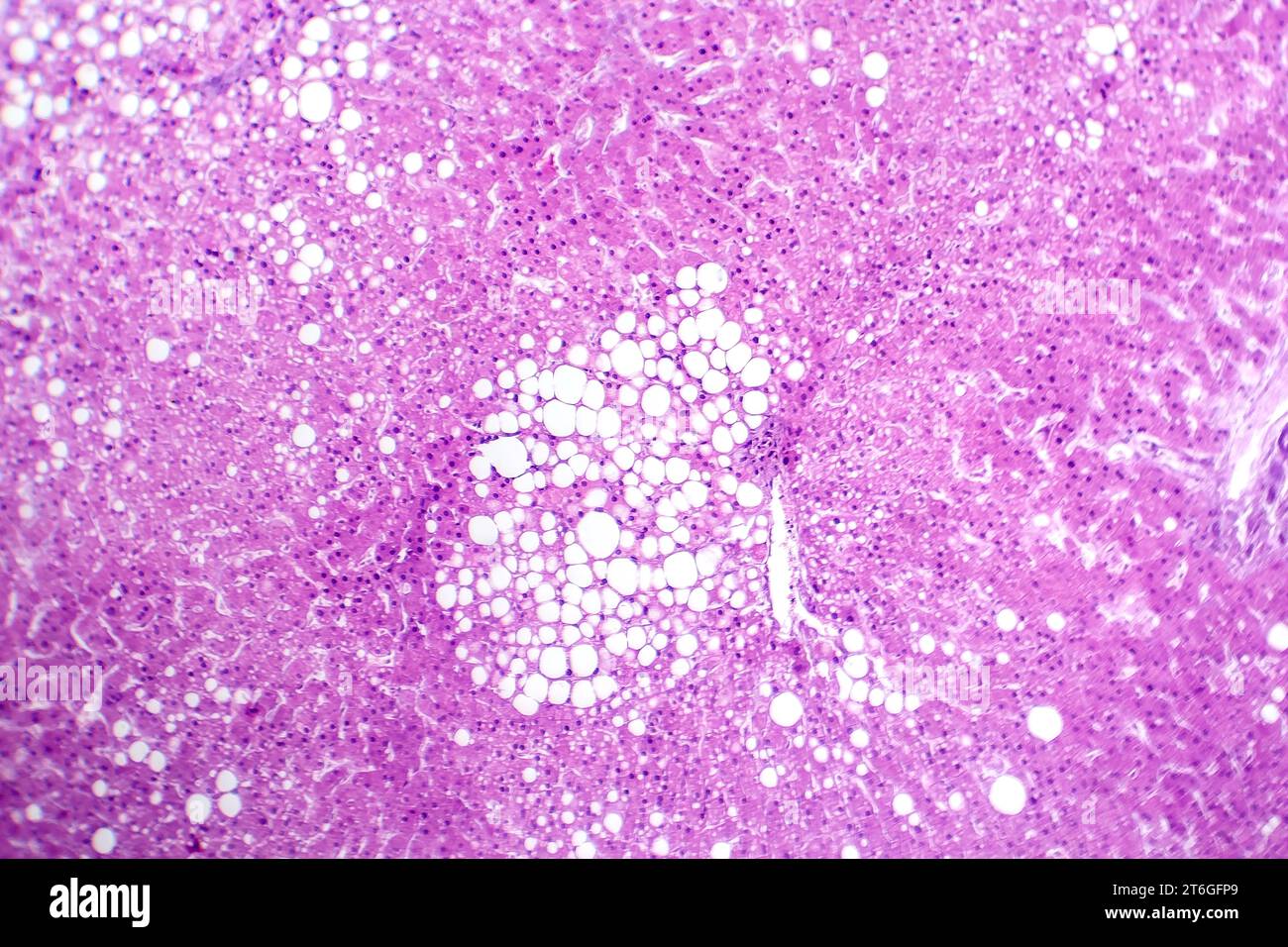 Photomicrograph of hepatic steatosis, revealing fat accumulation in ...