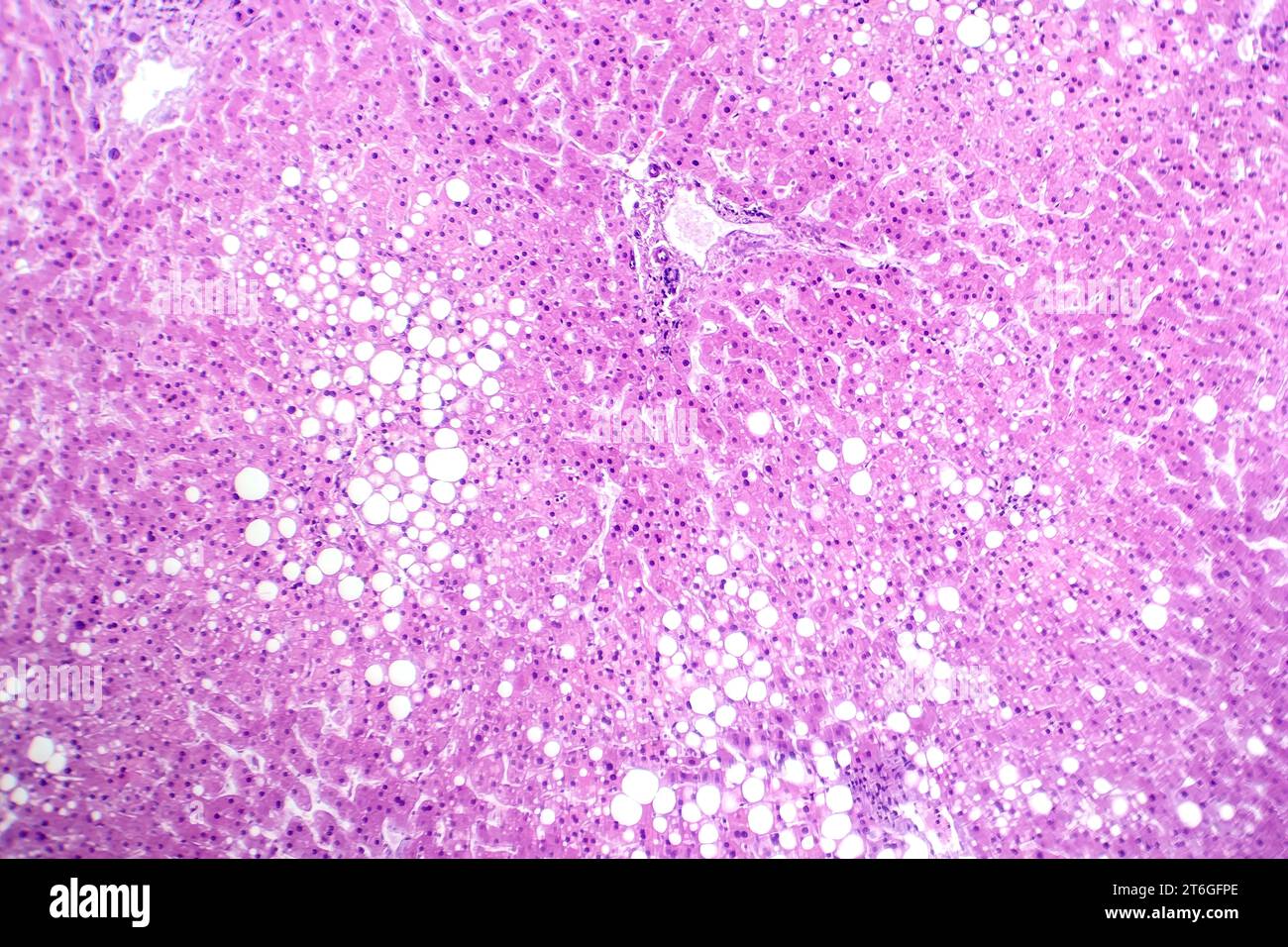 Photomicrograph of hepatic steatosis, revealing fat accumulation in ...