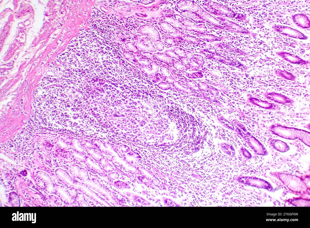 Photomicrograph of intestinal metaplasia, displaying transformation of ...