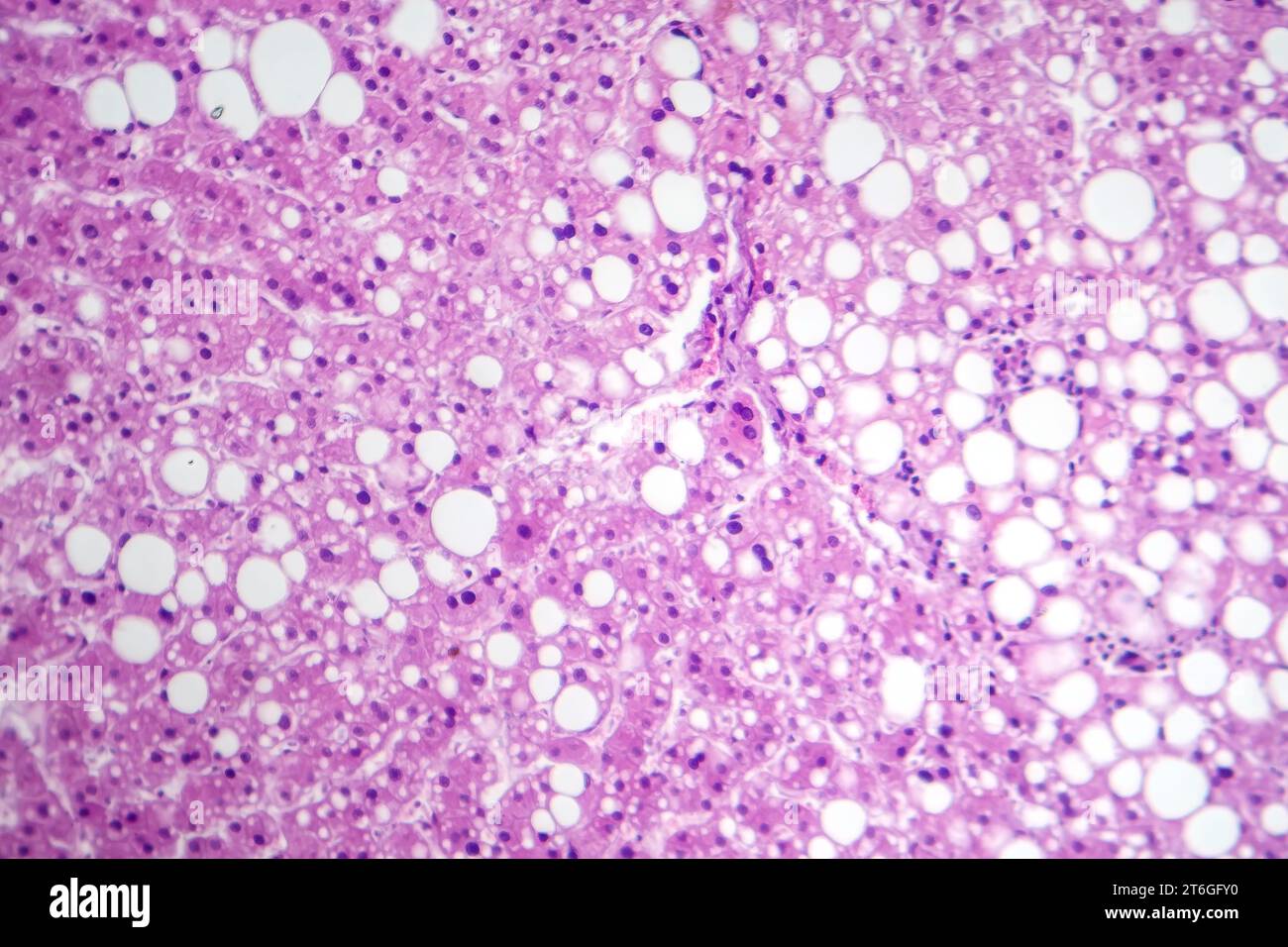 Photomicrograph of hepatic steatosis, revealing fat accumulation in ...