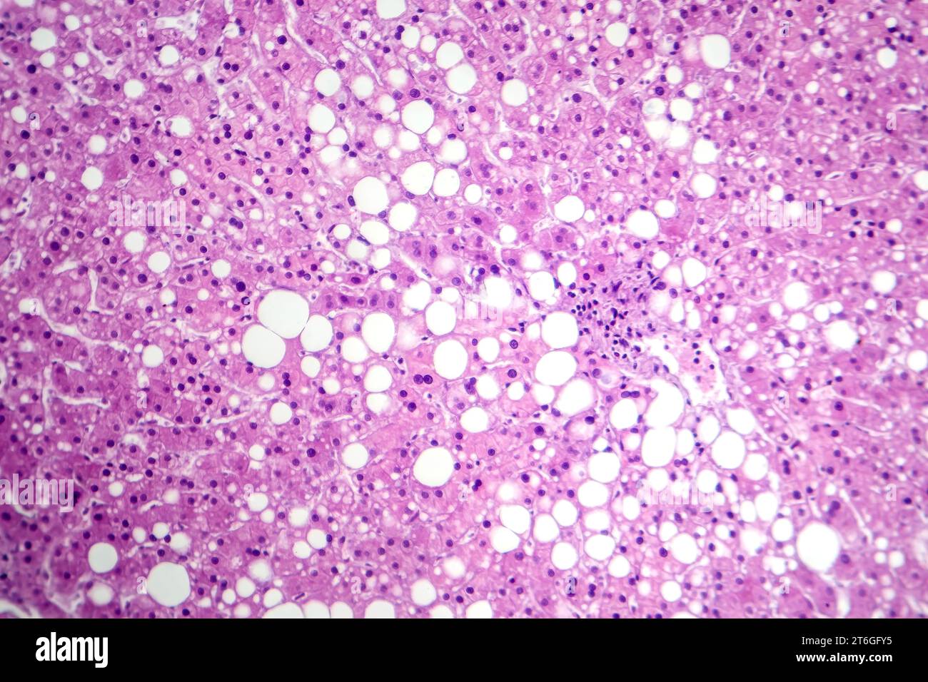 Photomicrograph of hepatic steatosis, revealing fat accumulation in ...