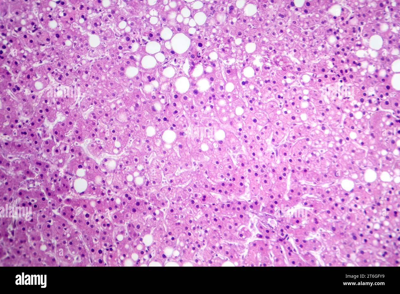 Photomicrograph of hepatic steatosis, revealing fat accumulation in ...
