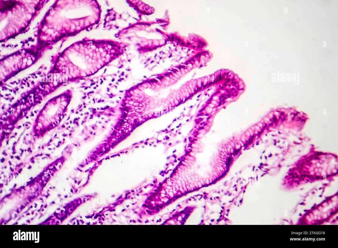 Photomicrograph of intestinal metaplasia, displaying transformation of ...