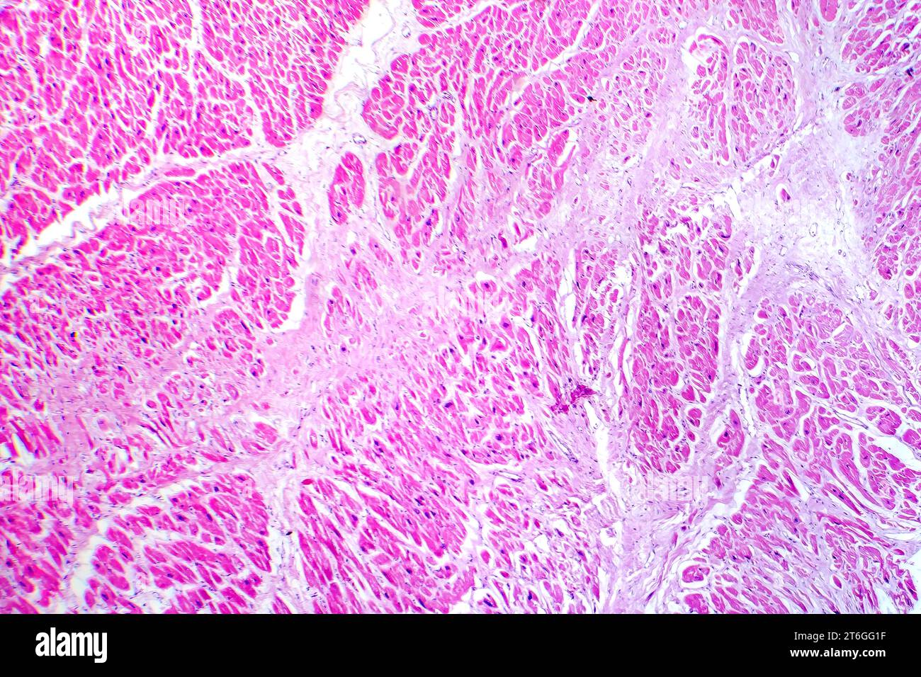 Photomicrograph of myocardial infarction, showing damaged heart tissue ...