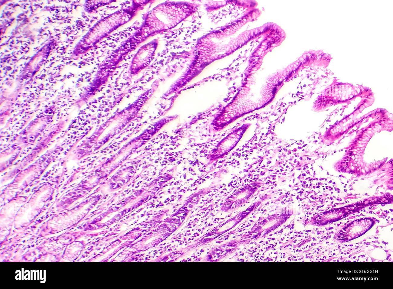 Photomicrograph of intestinal metaplasia, displaying transformation of ...