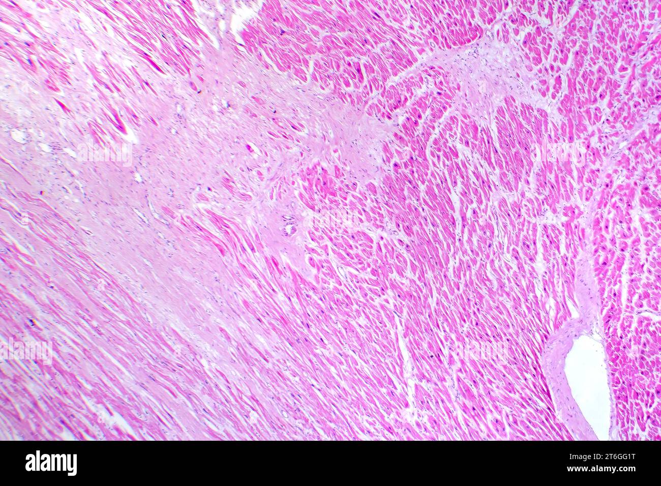 Photomicrograph of myocardial infarction, showing damaged heart tissue ...