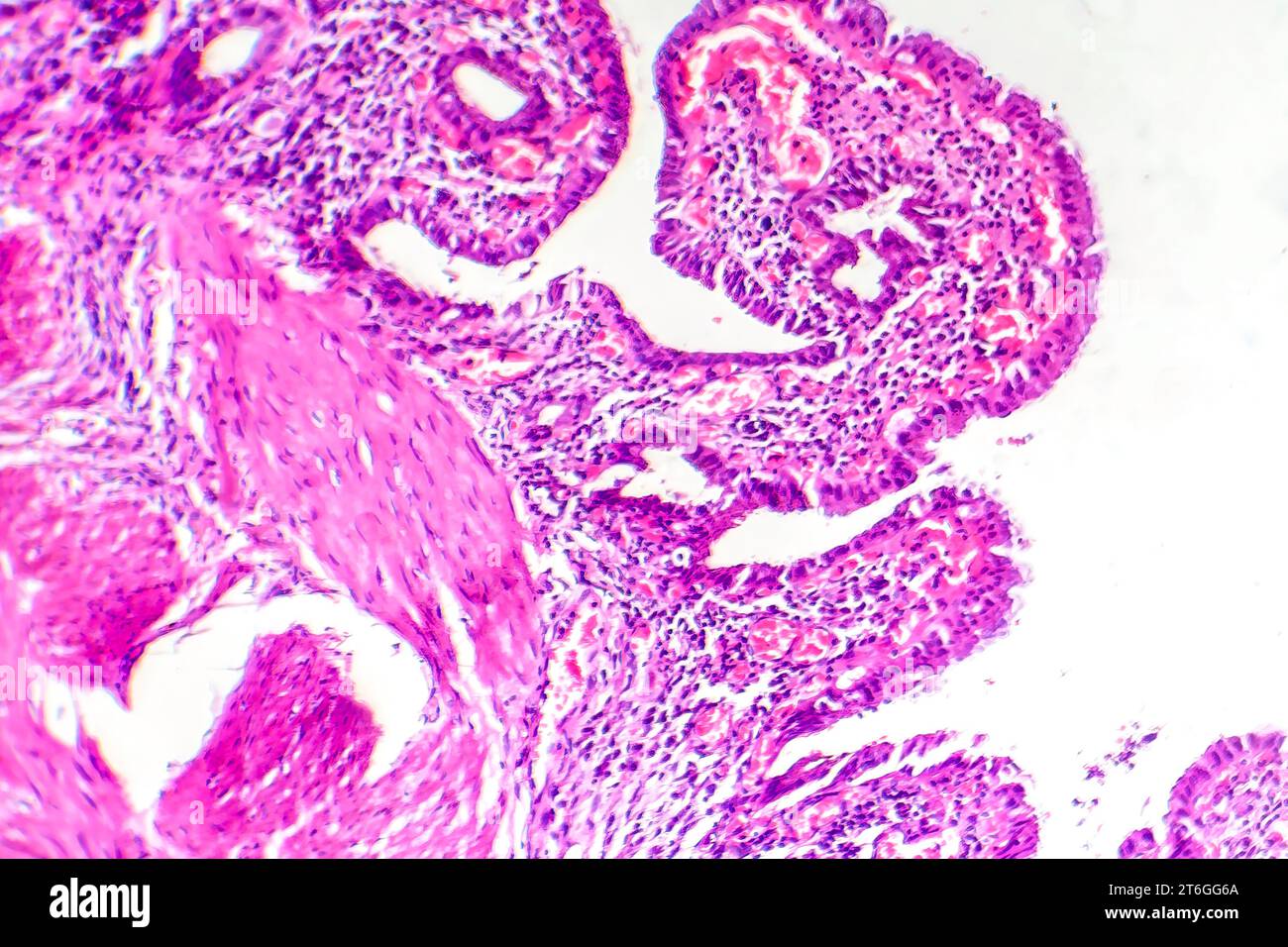 Photomicrograph of chronic cholecystitis, showcasing inflammation and ...