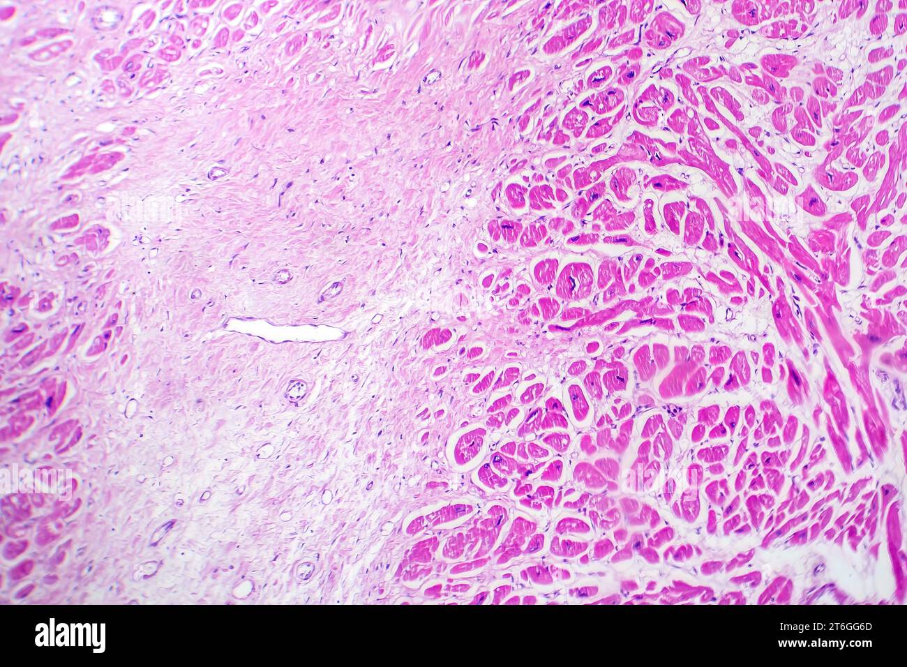 Photomicrograph of myocardial infarction, showing damaged heart tissue ...