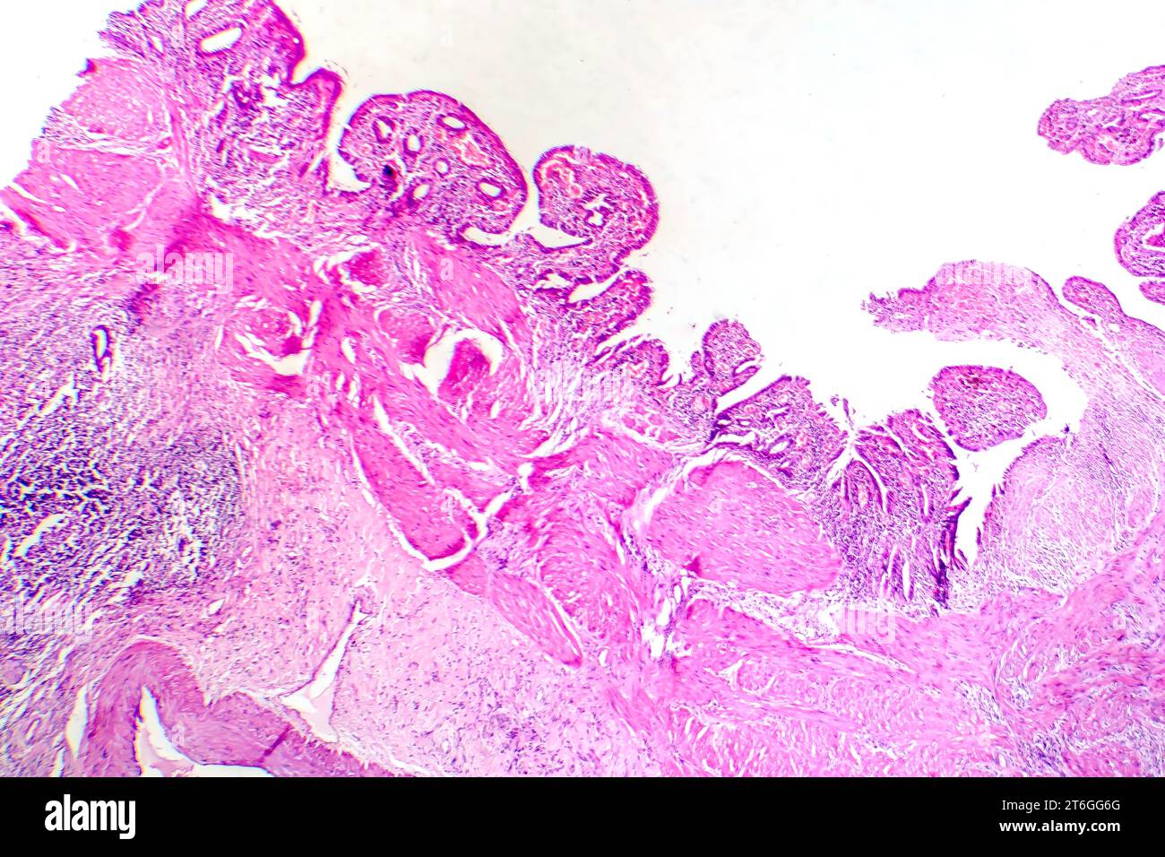 Photomicrograph of chronic cholecystitis, showcasing inflammation and ...
