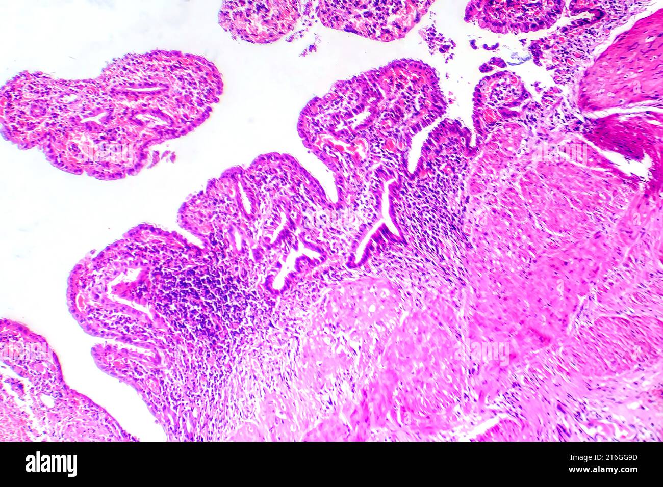 Photomicrograph of chronic cholecystitis, showcasing inflammation and ...
