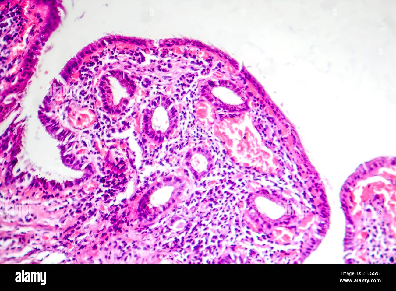 Photomicrograph of chronic cholecystitis, showcasing inflammation and ...