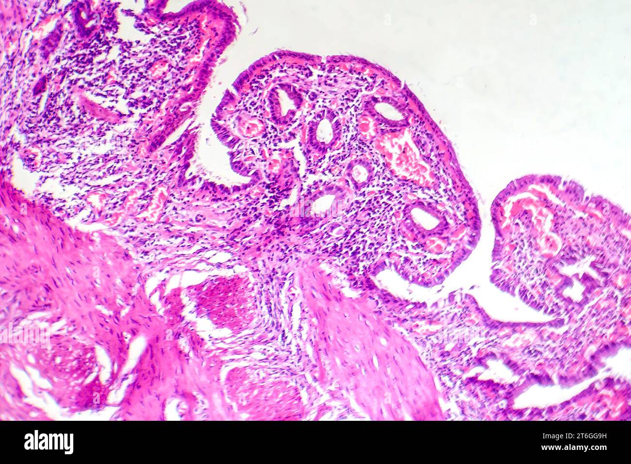 Photomicrograph of chronic cholecystitis, showcasing inflammation and ...
