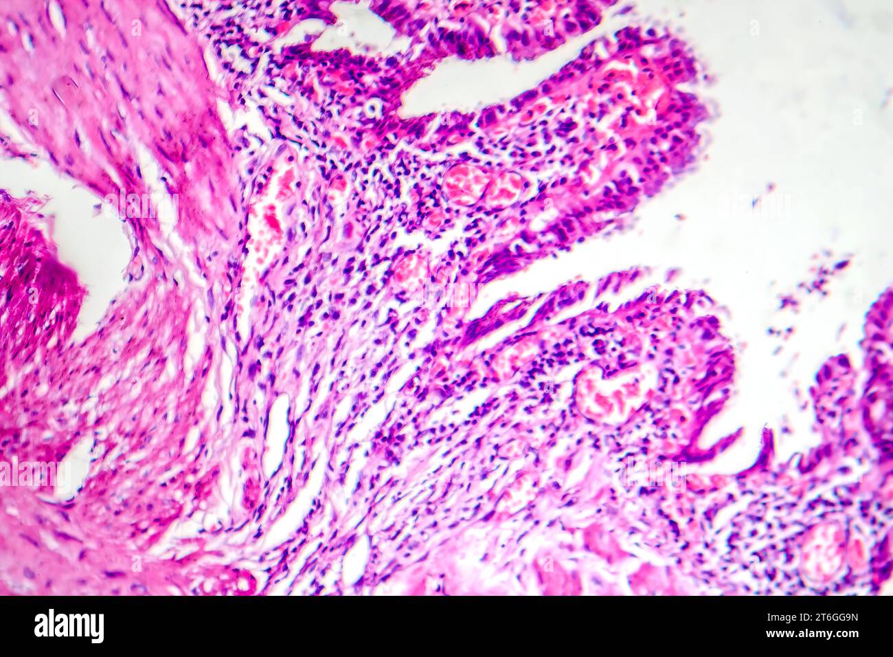 Photomicrograph of chronic cholecystitis, showcasing inflammation and ...