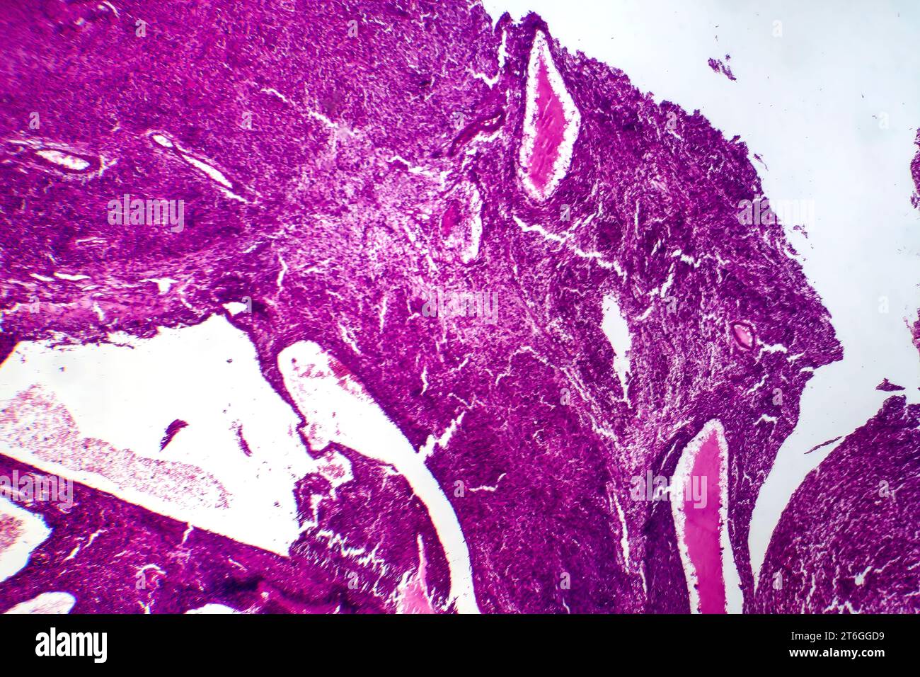 Photomicrograph of fibrosarcoma, revealing malignant fibroblasts and ...