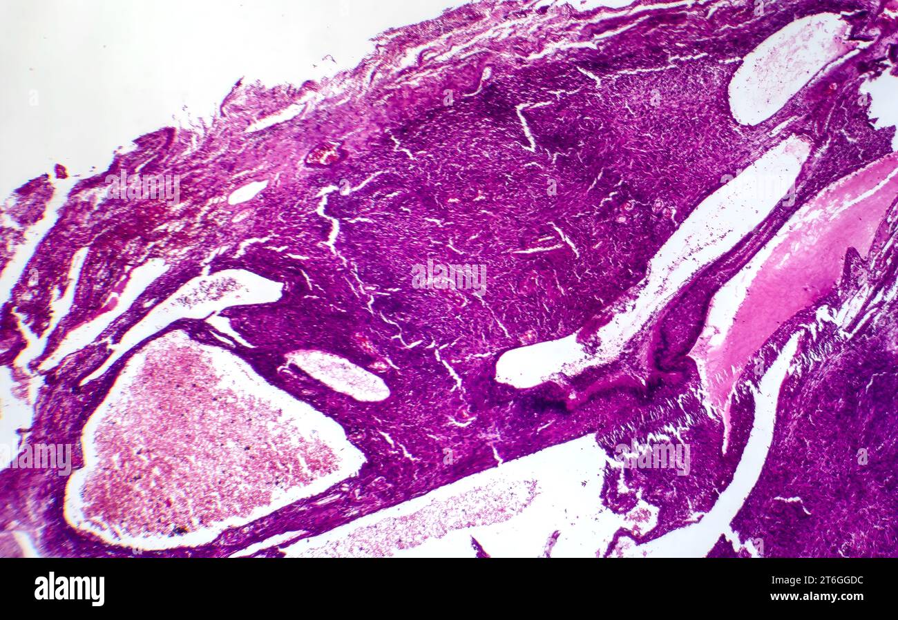 Photomicrograph of fibrosarcoma, revealing malignant fibroblasts and ...