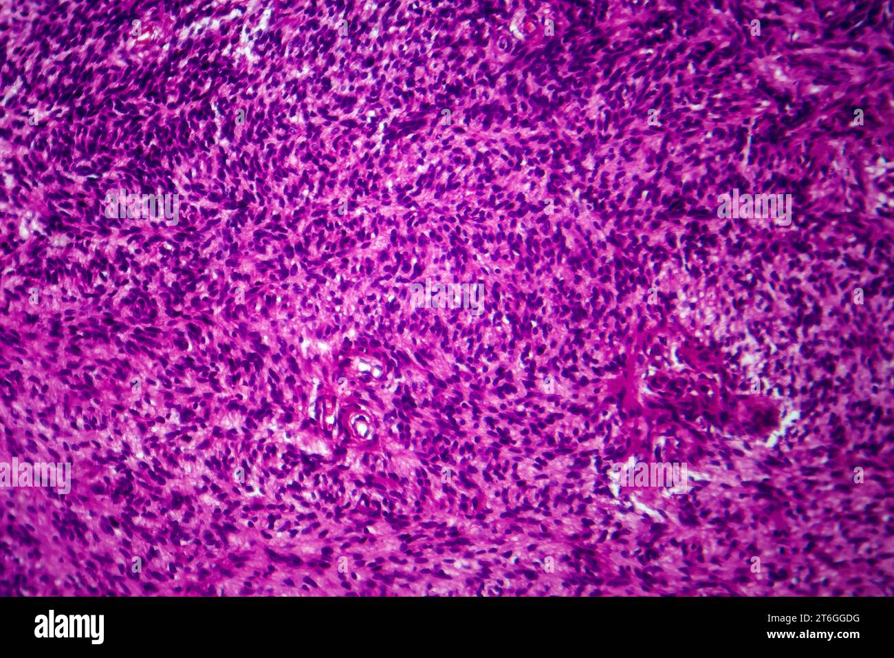 Photomicrograph of fibrosarcoma, revealing malignant fibroblasts and ...