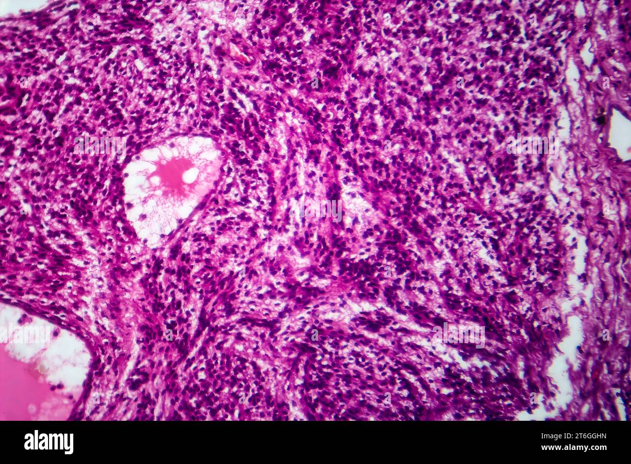 Photomicrograph of fibrosarcoma, revealing malignant fibroblasts and ...