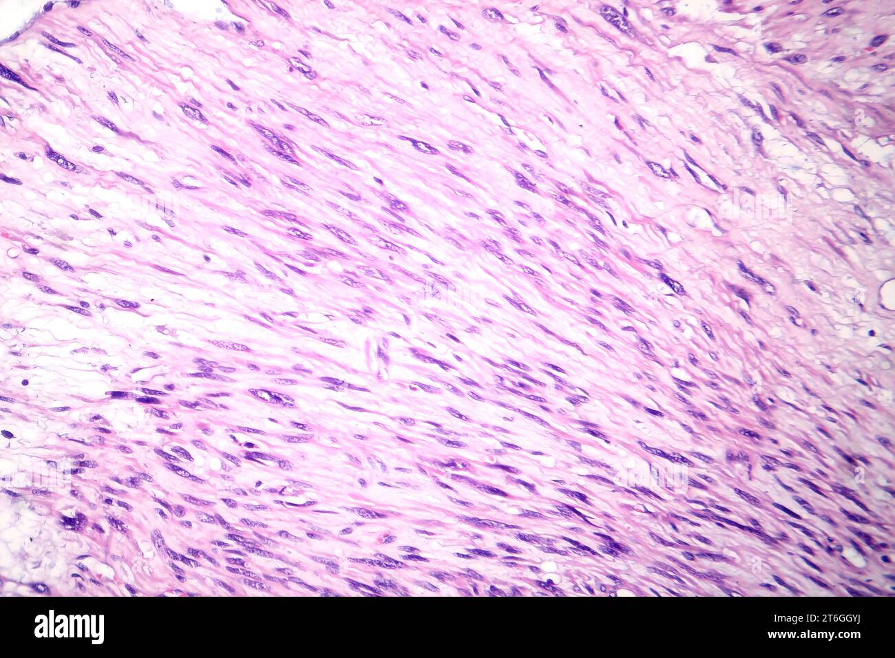 Photomicrograph of leiomyosarcoma, depicting malignant smooth muscle ...