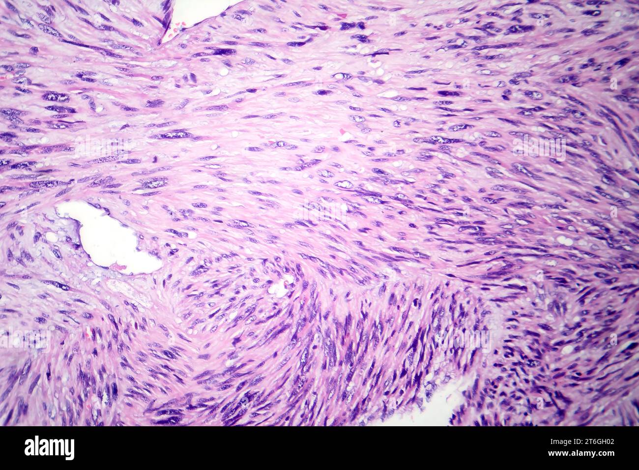 Photomicrograph of leiomyosarcoma, depicting malignant smooth muscle ...