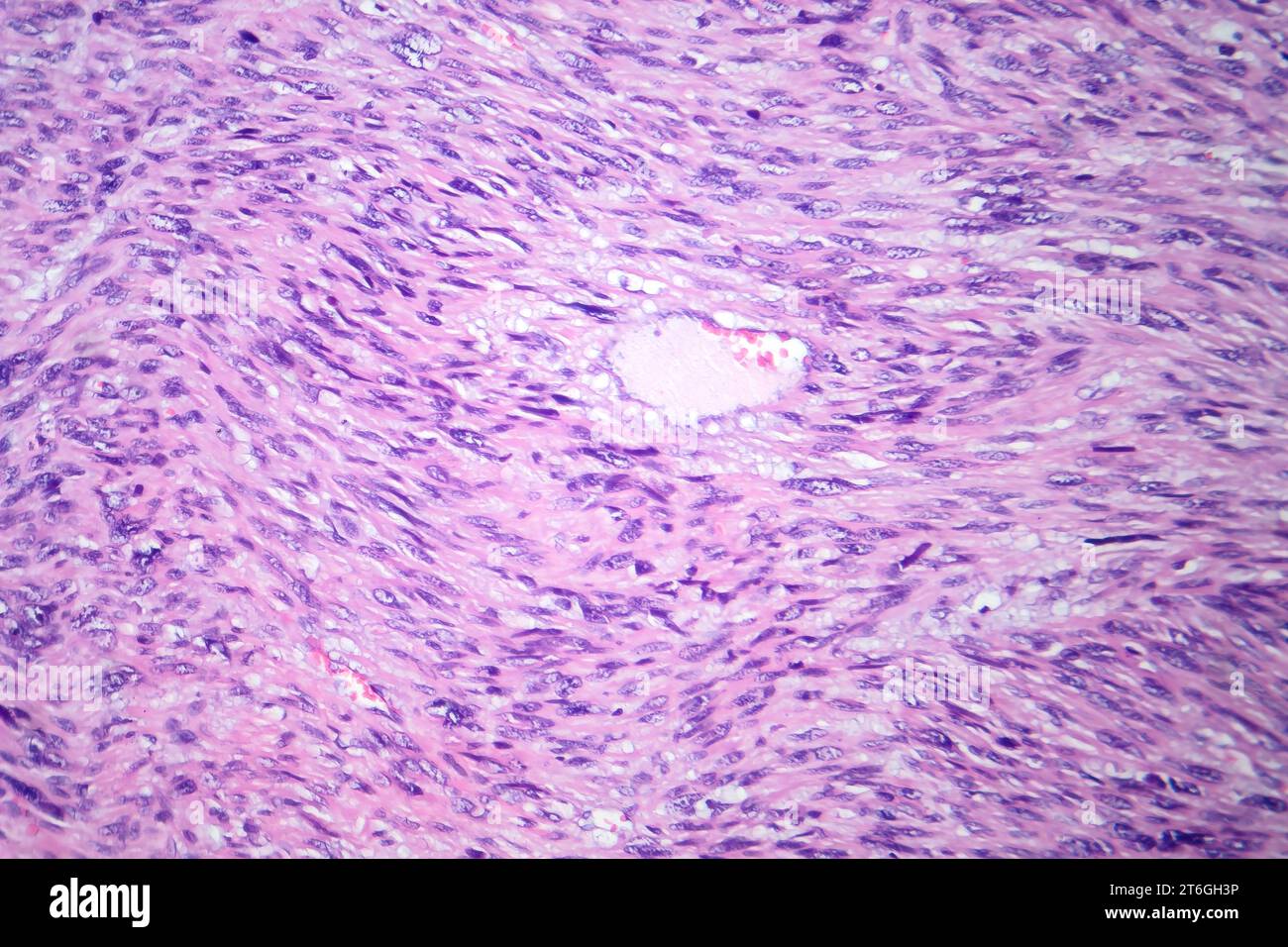 Photomicrograph of leiomyosarcoma, depicting malignant smooth muscle ...