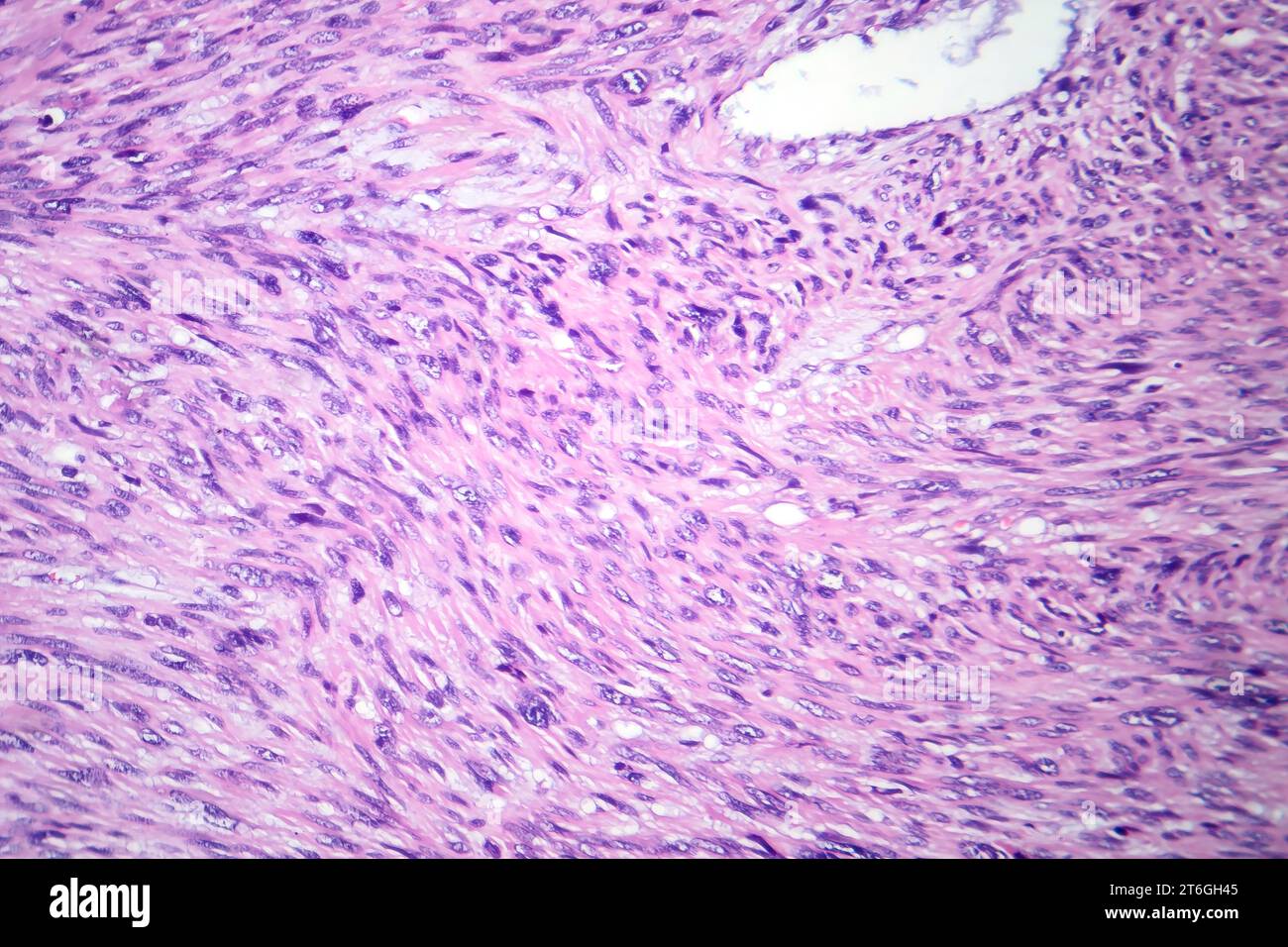 Photomicrograph of leiomyosarcoma, depicting malignant smooth muscle ...