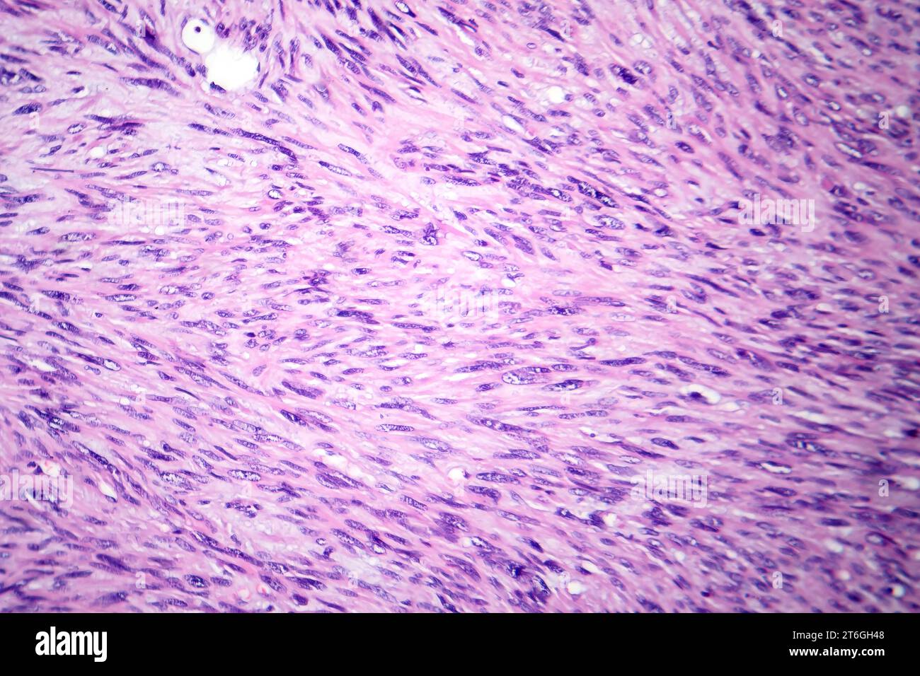 Photomicrograph of leiomyosarcoma, depicting malignant smooth muscle ...