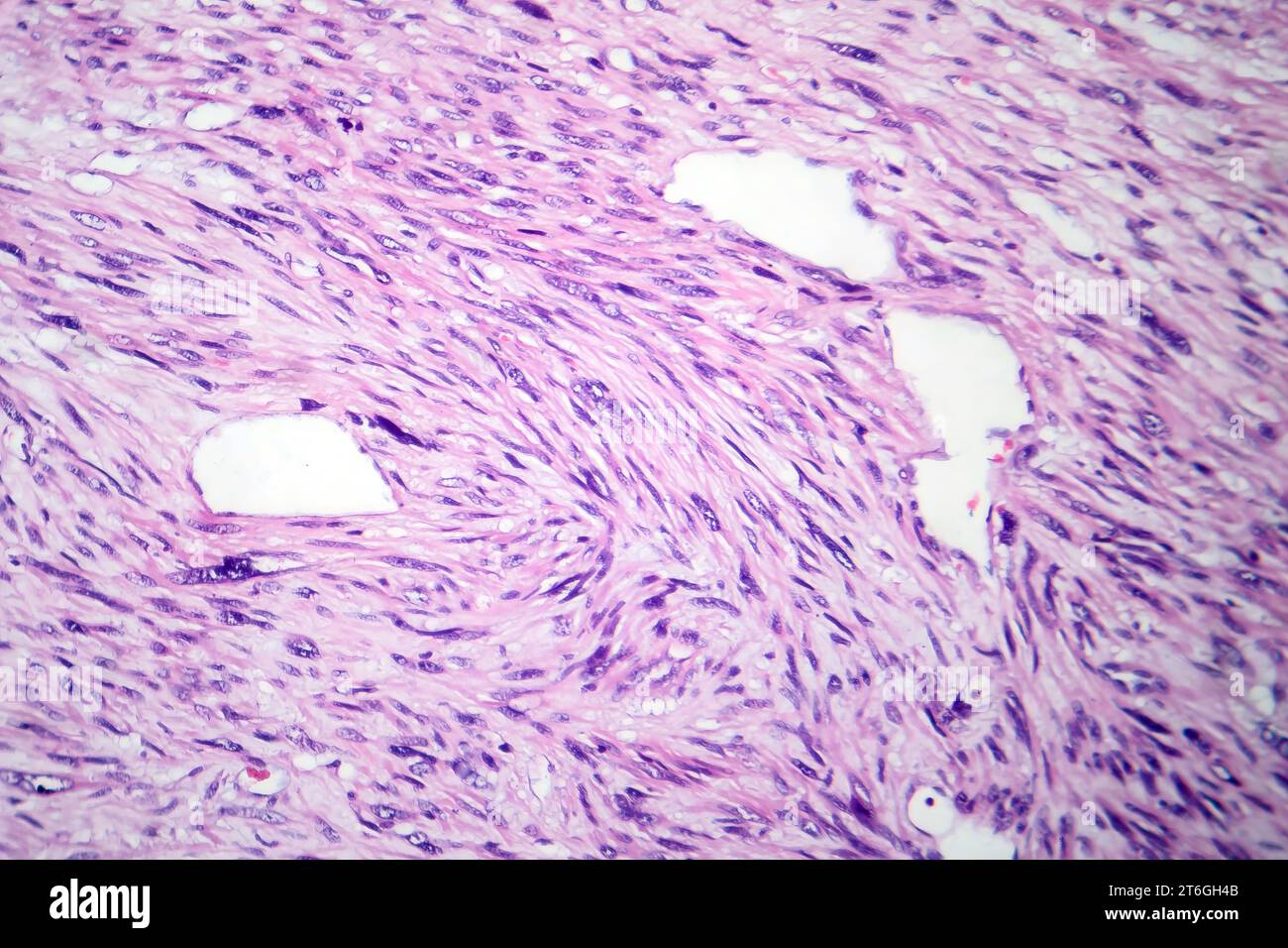 Photomicrograph of leiomyosarcoma, depicting malignant smooth muscle ...
