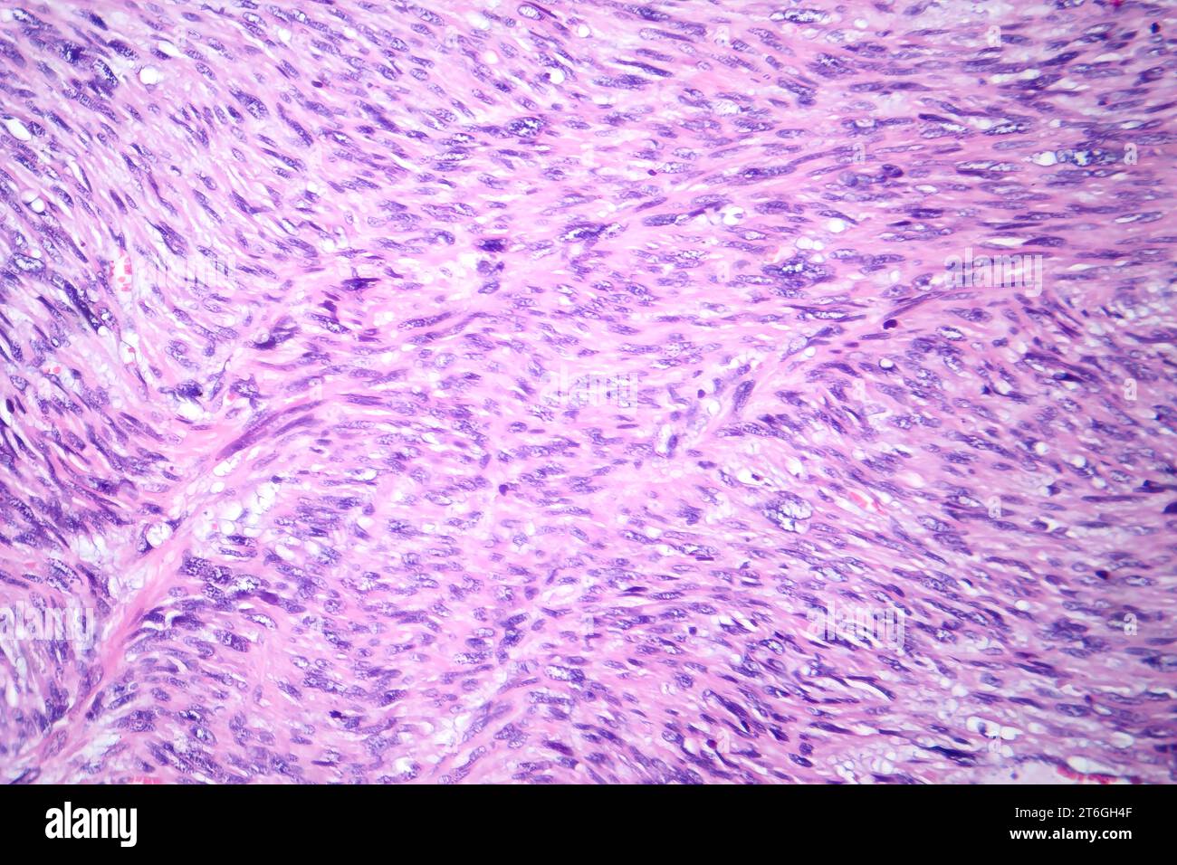 Photomicrograph of leiomyosarcoma, depicting malignant smooth muscle ...