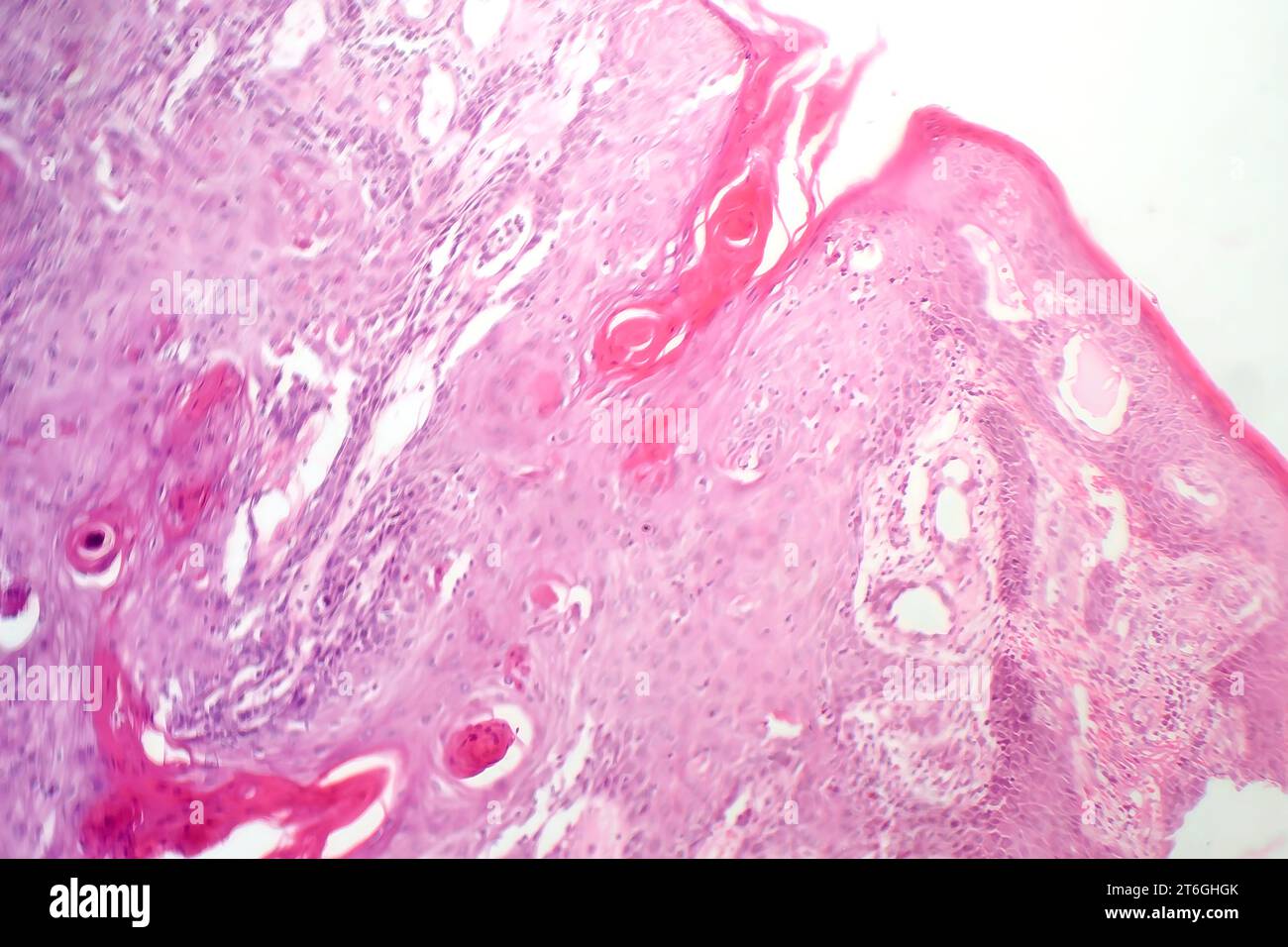 Photomicrograph of mucinous carcinoma in the stomach, displaying ...
