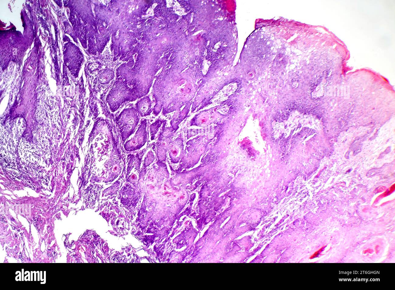 Photomicrograph of cutaneous squamous cell carcinoma, depicting ...