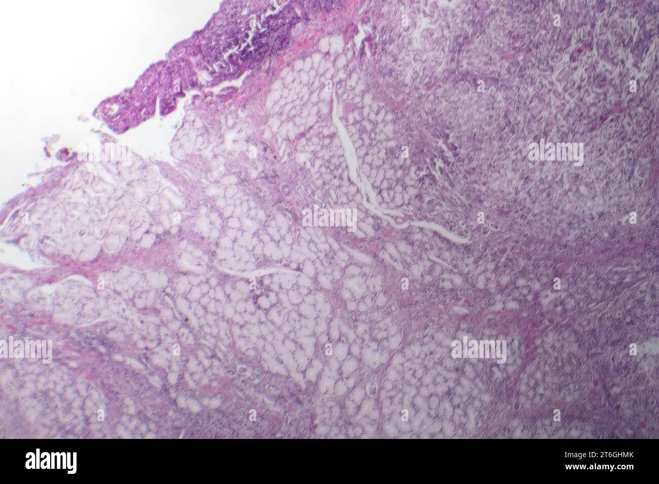 Cancer of the stomach histology hi-res stock photography and images - Alamy