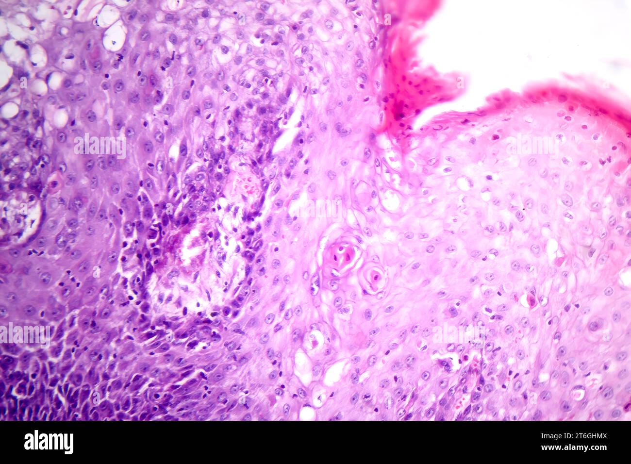 Photomicrograph of mucinous carcinoma in the stomach, displaying ...